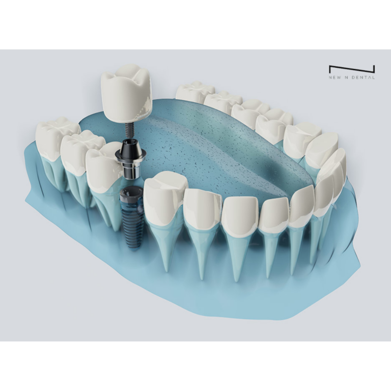 One-Day Implant: Fast, Precise Treatment at NEW N Dental